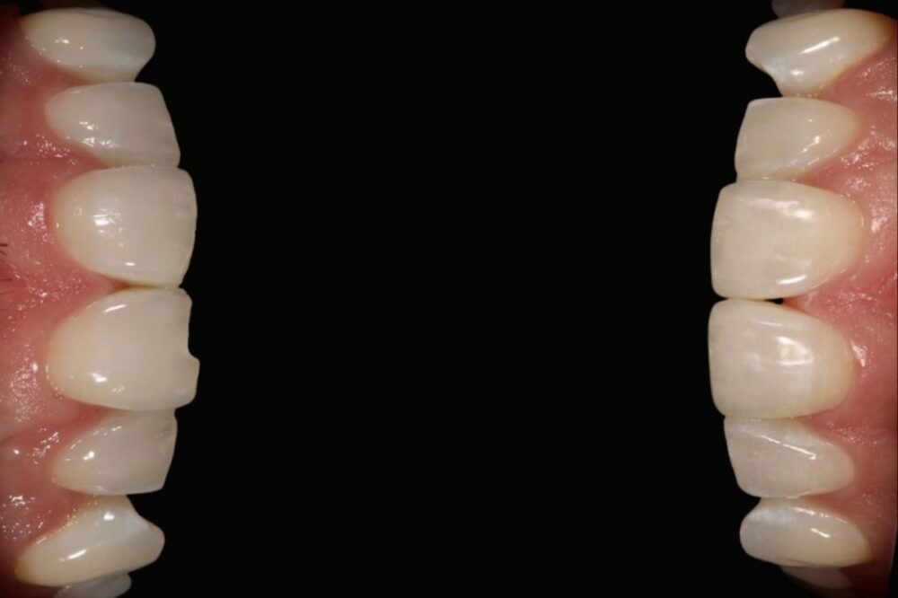 Why Do My Teeth Chip So Easily? - Kelmscott Dental