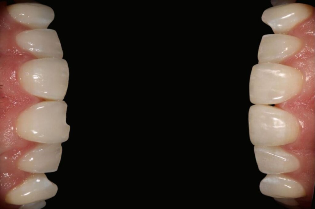 Why Do My Teeth Chip So Easily? - Kelmscott Dental