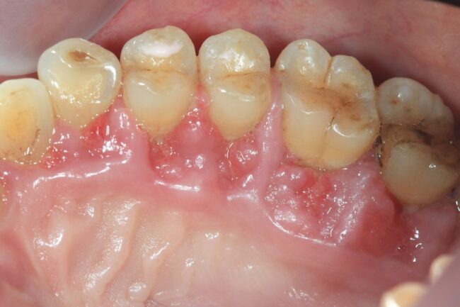 When Is It Too Late to Save a Tooth? - Kelmscott Dental