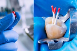 When Is It Too Late to Save a Tooth? - Kelmscott Dental