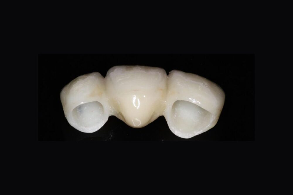 When Is It Too Late to Save a Tooth? - Kelmscott Dental