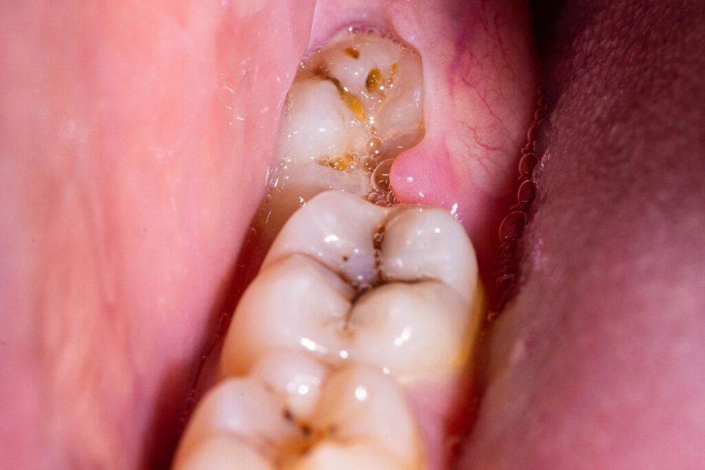 When Is It Too Late to Save a Tooth? - Kelmscott Dental