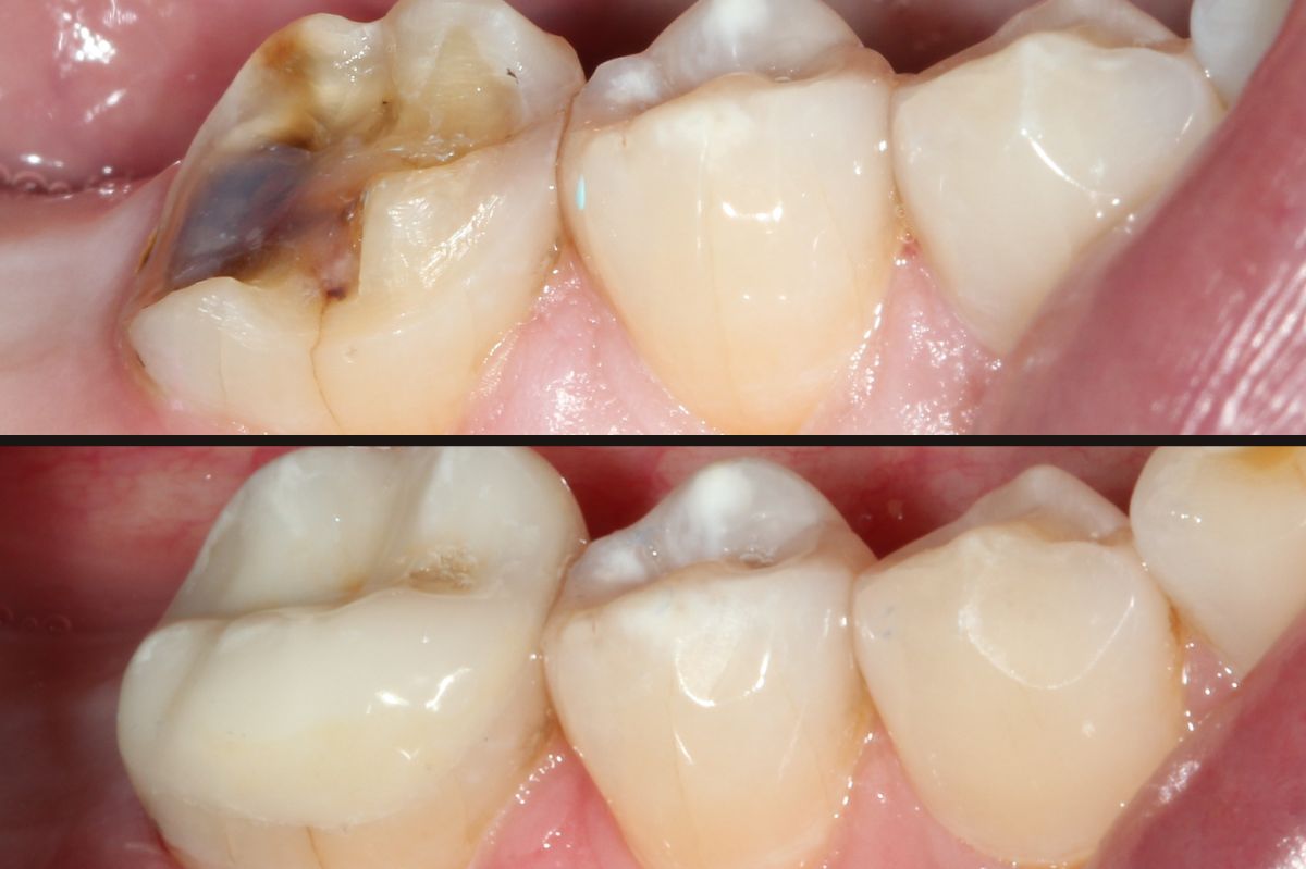 When Is It Too Late To Save A Tooth Kelmscott Dental
