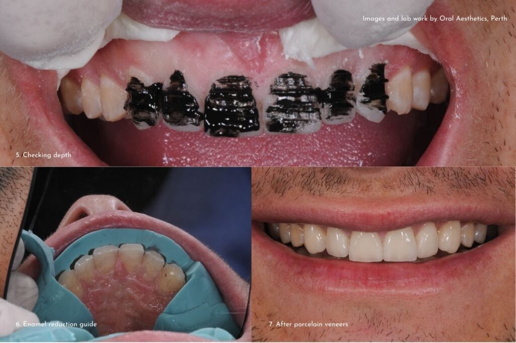 Are Veneers Reversible? - Kelmscott Dental
