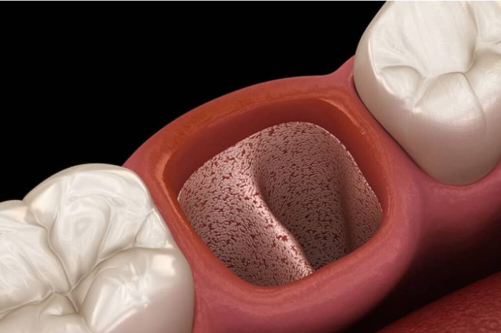 Wisdom Teeth Removal: How to Avoid Dry Socket - Kelmscott Dental