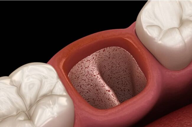 Wisdom Teeth Removal: How to Avoid Dry Socket - Kelmscott Dental