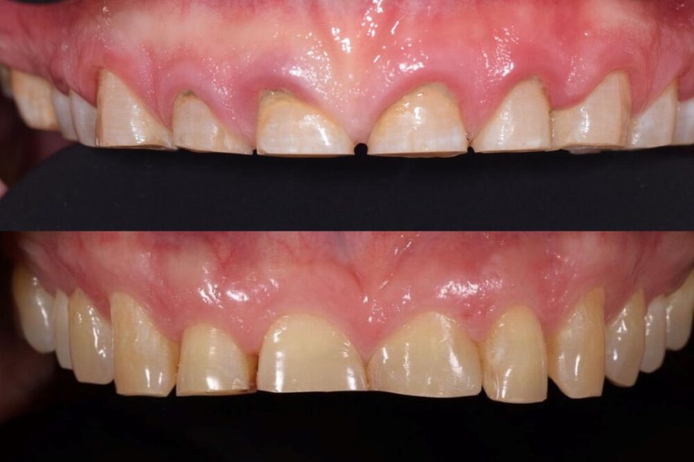 How Can My Dentist Tell If I Grind My Teeth? - Kelmscott Dental