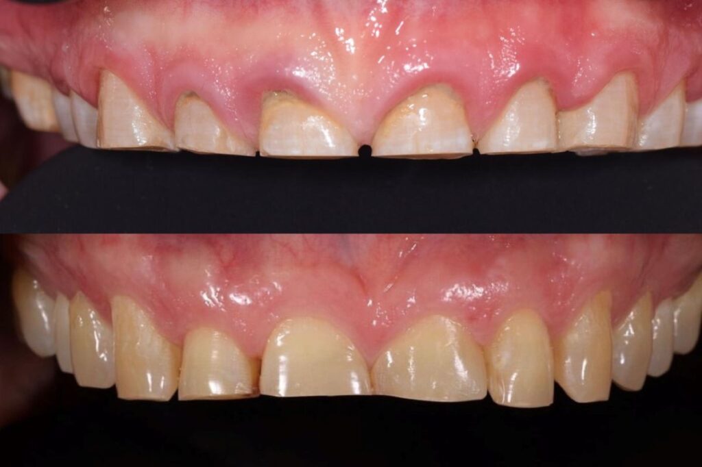 How Can My Dentist Tell If I Grind My Teeth? - Kelmscott Dental